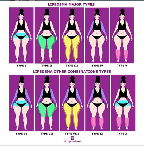 Lipedema Lipedema Revolution