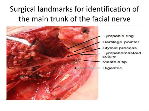 Parotidectomy Pptx