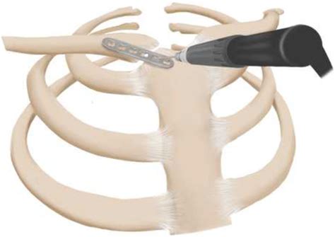 Surgical Treatment For Sternoclavicular Joint Dislocations Pmc