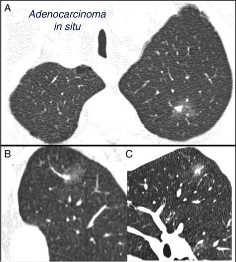 Normativa Sobre El Manejo Del Nódulo Pulmonar Solitario Archivos De