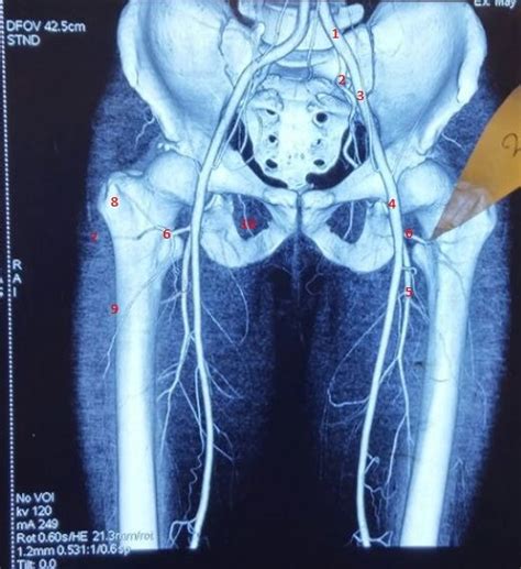 Lower Limb Angio Ct Diagram Quizlet