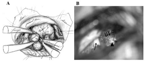 Operative Schema A And Photograph B The Trigeminal Nerve