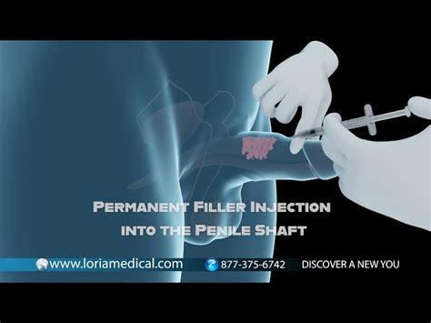 Penile Enlargement With Permanent Filler How Is Done Nova Bioscience
