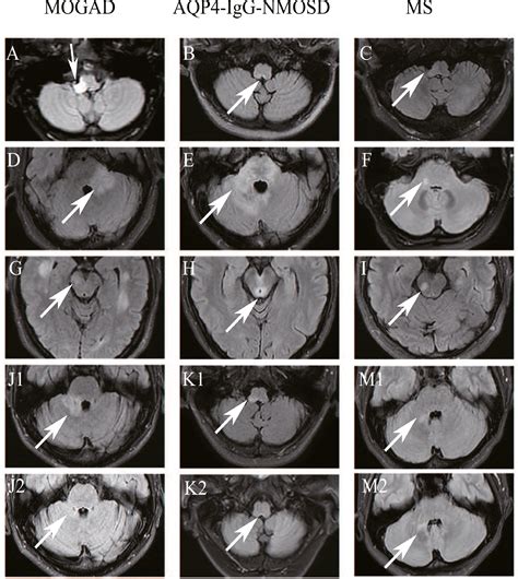 Clinical Features Of Mogad With Brainstem Involvement In The Initial