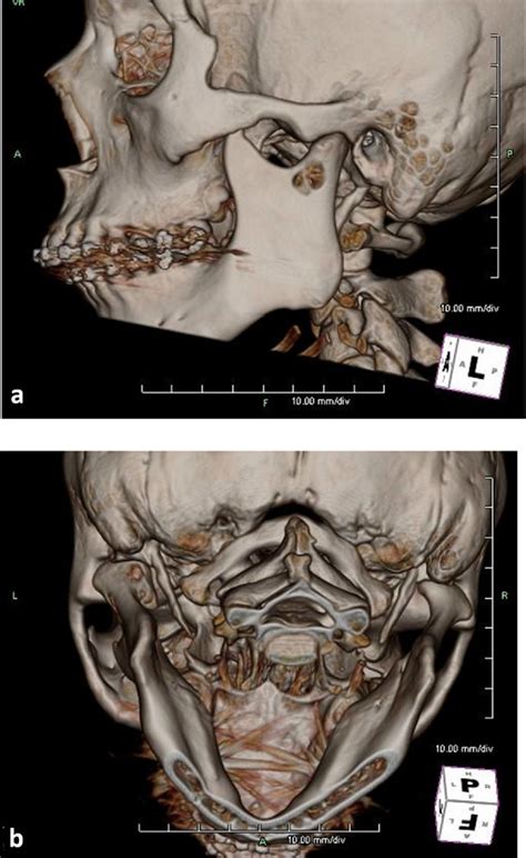 Figure 3 From Multilocular Radiolucency Of The Mandibular Condyle In A