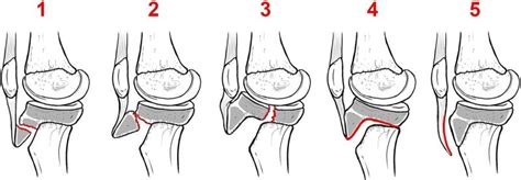 Sagittal Fragment Rotation And Ogden Type I Classification Are Hallmarks Of Combined Tibial