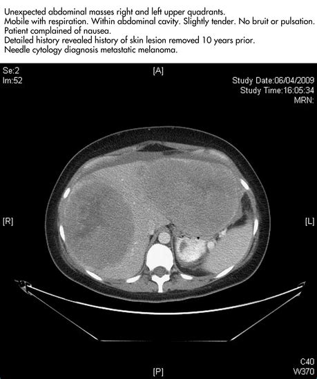 Palpable Asymptomatic Abdominal Masses Clinical Gateclinical Gate