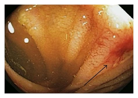 Findings In The Terminal Ileum An Ulcer Black Arrow Is Seen 3 Cm Download Scientific Diagram