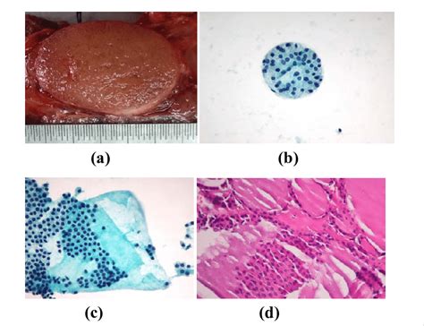 Benign Colloidal Nodules A Macroscopic Encapsulated Homogeneous
