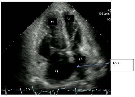 Four Chamber Views Of Tte Echo Image Demonstrates Right Atrial And Download Scientific Diagram