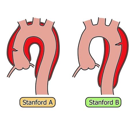 Aortic Dissection Stanford Over 4 Royalty Free Licensable Stock