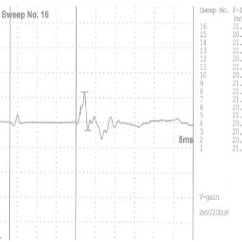 Tibial Nerve F Waves Latency Of 20 Ms Reveal An F Wave Relationship