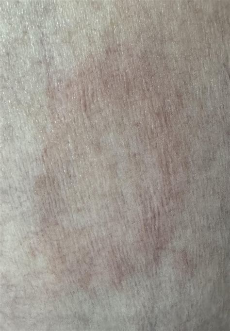 Annular Rashlesion With Central Clearing Rdermatologyquestions