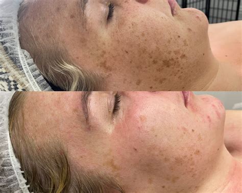 The Best Way To Help Prevent Hyperpigmentation On Your Skin Skincare