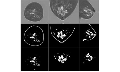 steps in the quantitative breast density algorithm top row speed of