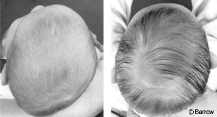 Diagnosis And Management Of Deformational Plagiocephaly Barrow