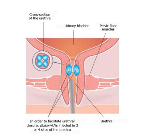 What Are Bulking Agents Szpital Medfemina Wrocław