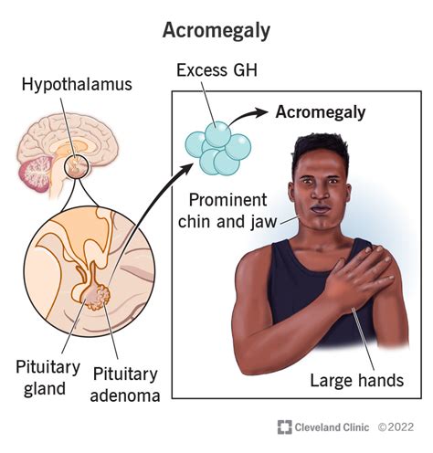 Acromegaly Causes Picture Symptoms Diagnosis Treatment