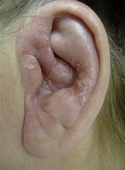 Ear Pinna Perichondritis At Erin Wright Blog