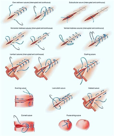 Medical Mnemonicss Instagram Photo Different Type Of Surgical