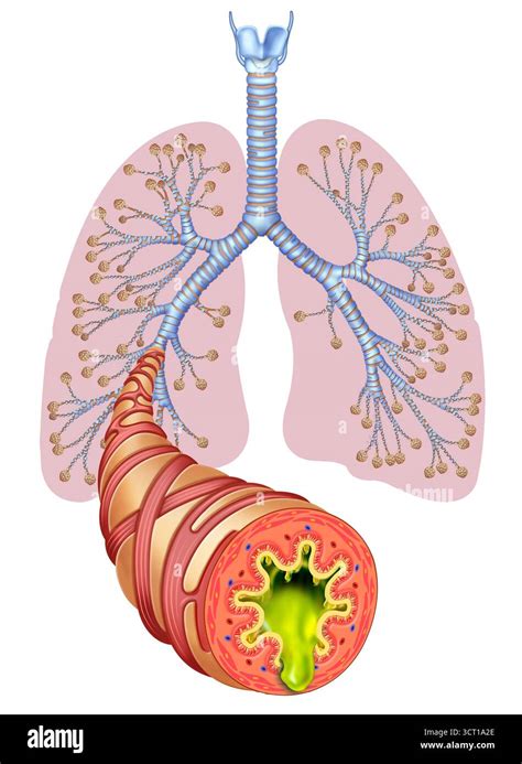 Illustration Of The Lungs And An Inflamed Bronchus Highlighted In The