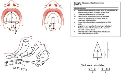 Figure 1 From Cleft Palates And Occlusal Outcomes In Pierre Robin