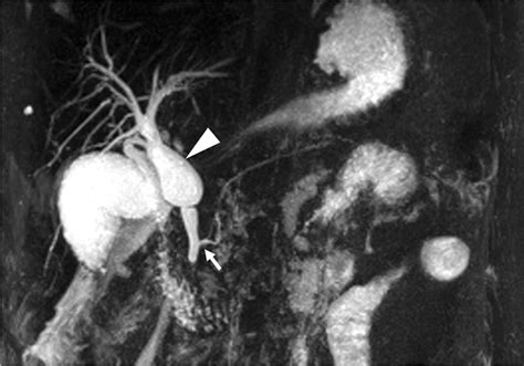 67 Year Old With Type 1c Choledochal Cyst 3d Mrcp Images Showing