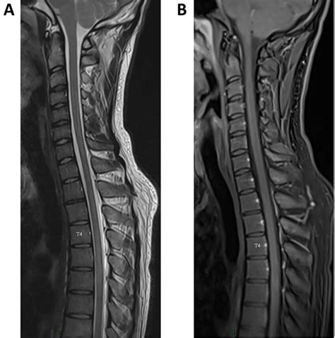 A Sagittal T2 Sequence Regression Of The Hyperintensity Of The