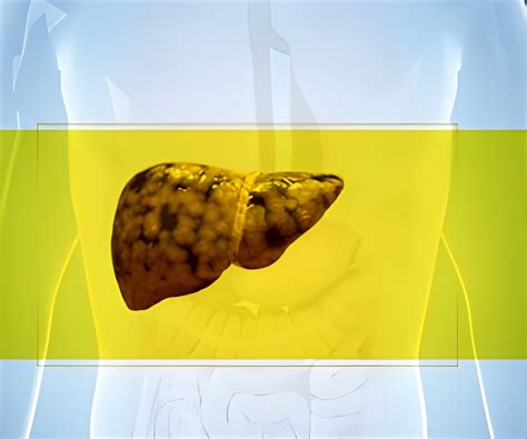 Ready To Fight Metabolic Dysfunction Associated Fatty Liver Disease