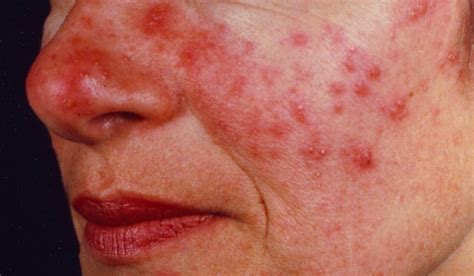 This Could Be The Reason Your Acne Wont Go Away