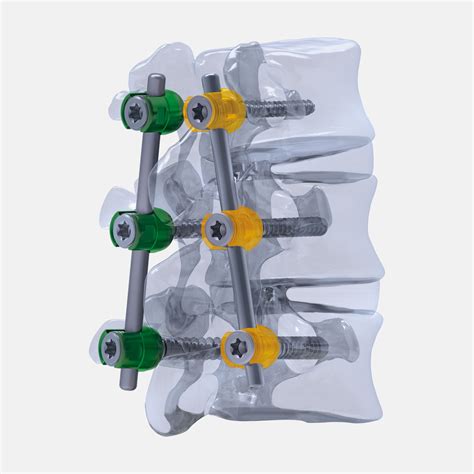 Spine Sis Medical Co Ltd