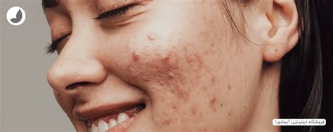 درمان جوش چرکی در 5 دقیقه آیمادورا