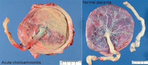Acute Chorioamnionitis Human Pathology Photos