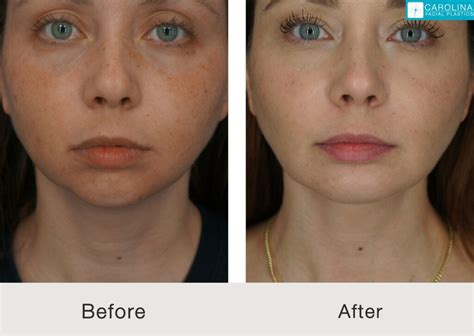 Get Rid Of Chubby Cheeks 5 Ways To Get Rid Of Chubby Cheeks Defined