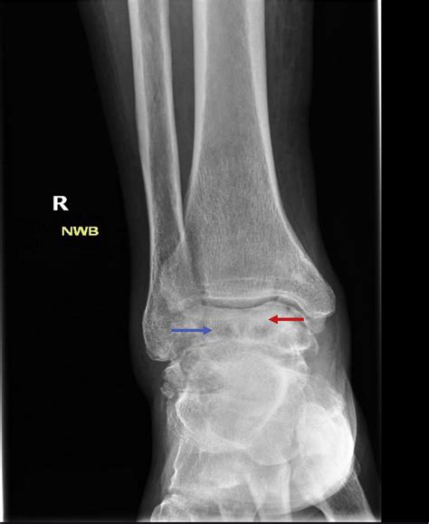 Imaging Features Of Avascular Necrosis Of The Foot And Ankle Foot And