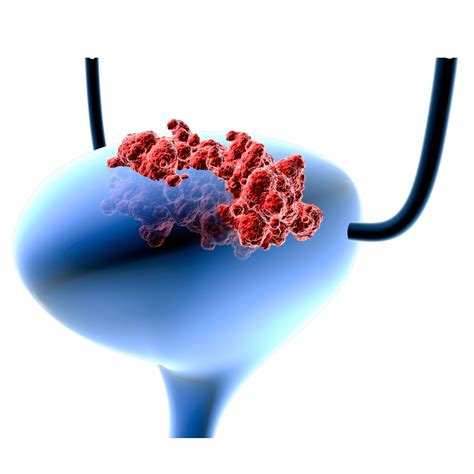 Case Study Leading Urology Centre