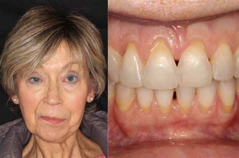 A Curious Case Of Occlusion Irish Dentistry