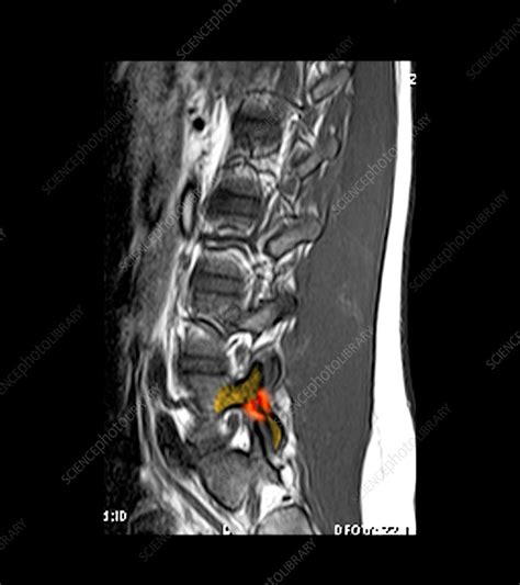 Mri Of L5 Spondylolysis Stock Image C0047479 Science Photo Library