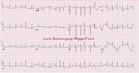 Mat Ecg Definition At Elizabeth Gardiner Blog