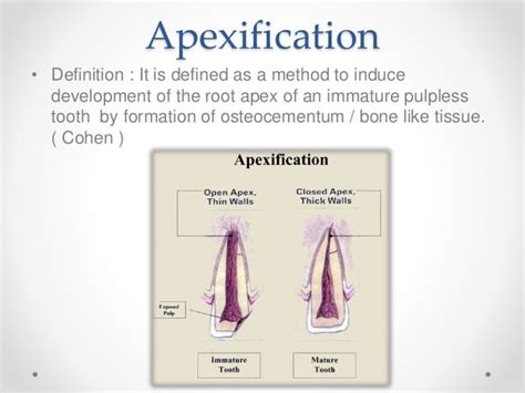 Apexogenesis And Apexification In Pediatric Dentistry
