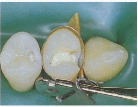 Class Ii Composite Restoration 6a Flashcards Quizlet