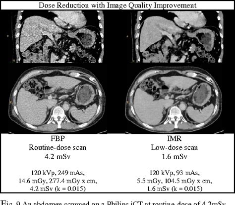 Figure 13 From Innovations Iterative Model Reconstruction Simultaneously Lowered Computed