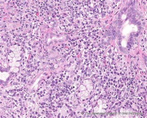 Mikulicz病 口腔病理基本画像アトラス