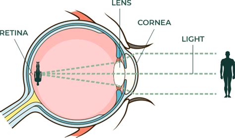 Eye Conditions Dr Robin Abell Cornea Cataract And Refractive Surgeon