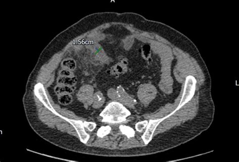 Diverticulitis And Diverticulosis Of The Appendix A Case Series Abstract Europe Pmc