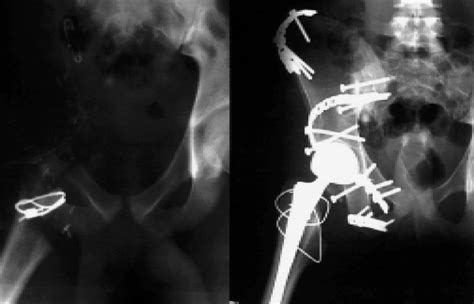 A Ischio Femoral Pseudarthrosis Following Resection Of Ewings Download Scientific Diagram