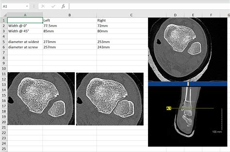 Broken Fibula Ankle Was Dislocated Mainly At The Tibiatibia Is Broken Fibula Ankle Was Dislocated Mainly At The Tibiatibia Is