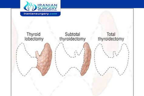 Types Of Thyroidectomy Thyroidectomy Steps Iranian Surgery