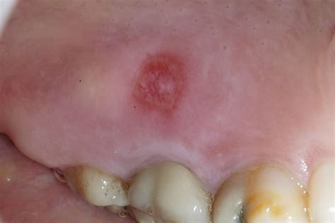 Mouth Ulcer Causes Symptoms Treatment And Cure Museum Dental Center