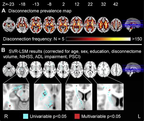 Structural Disconnection Prevalence Map And Disconnection Symptom